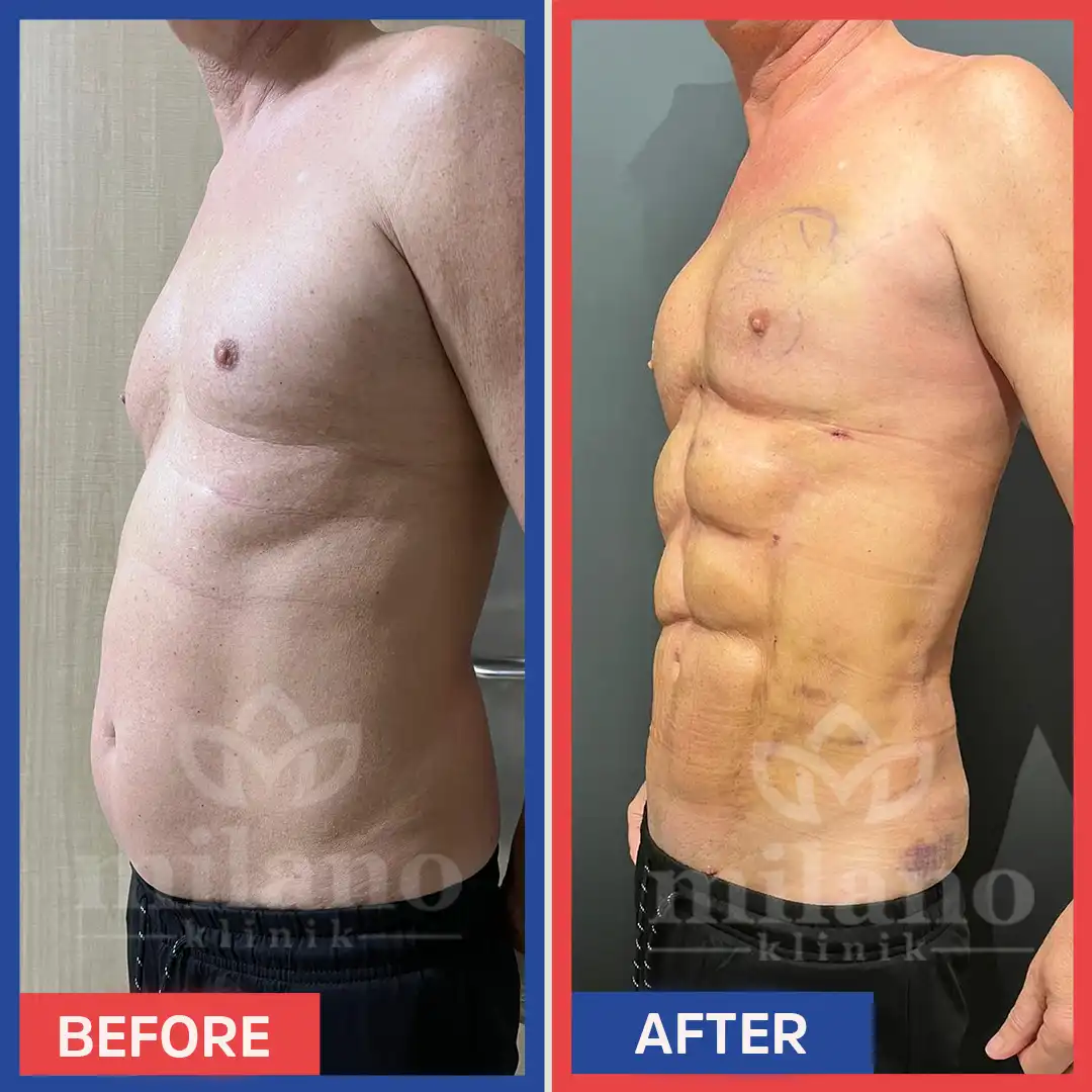 Six Pack Surgery Prices in Turkey 2024 - Milano Clinic