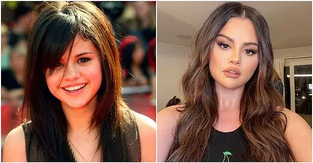 Selena Gomez Plastic Surgery - Milano Klinik