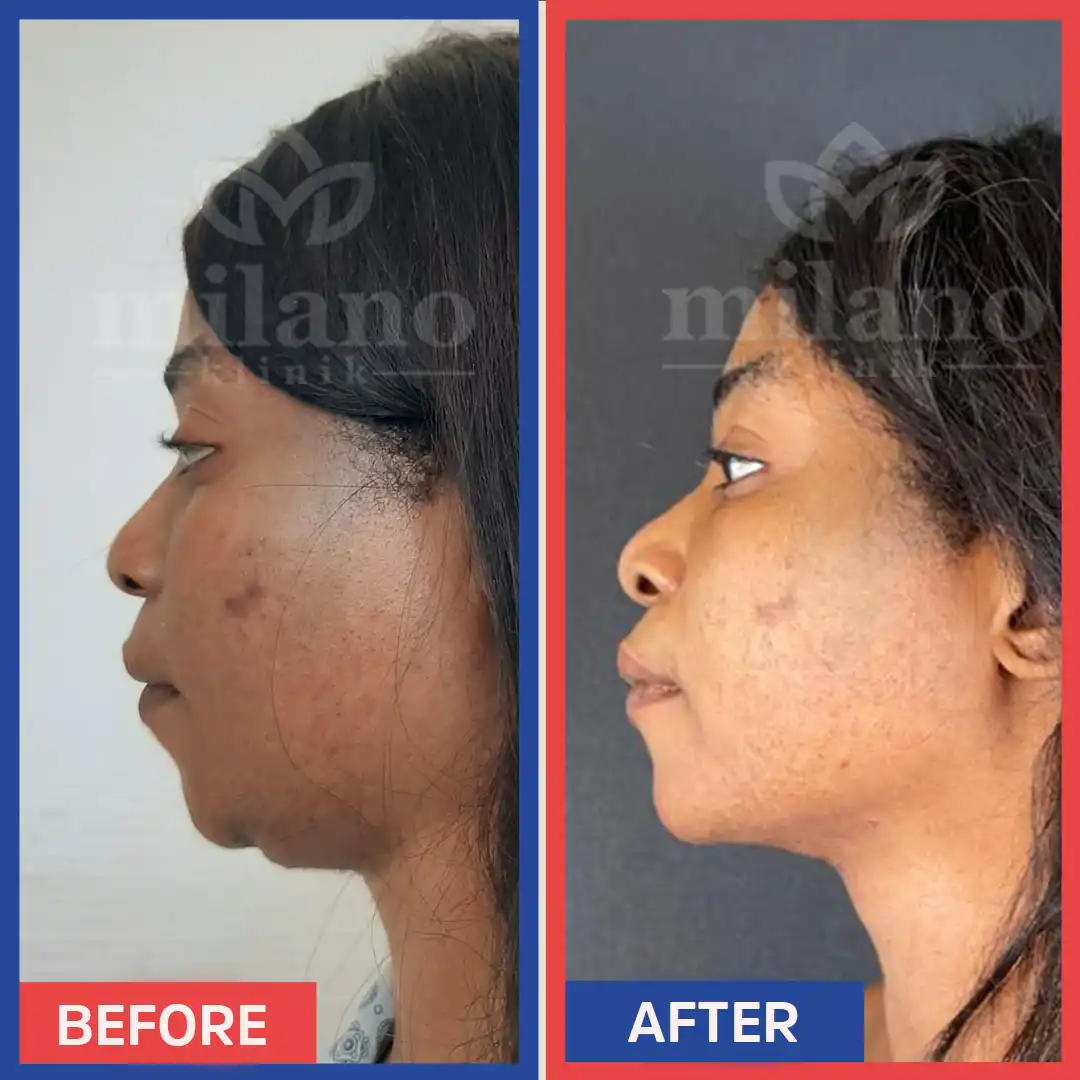 Fettabsaugung Hals Kosten - Milano Klinik